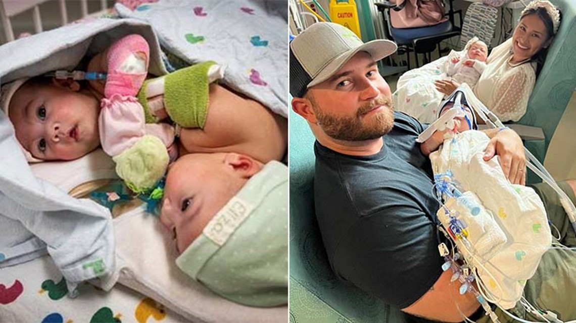 Conjoined twins in Houston head home after being separated ...