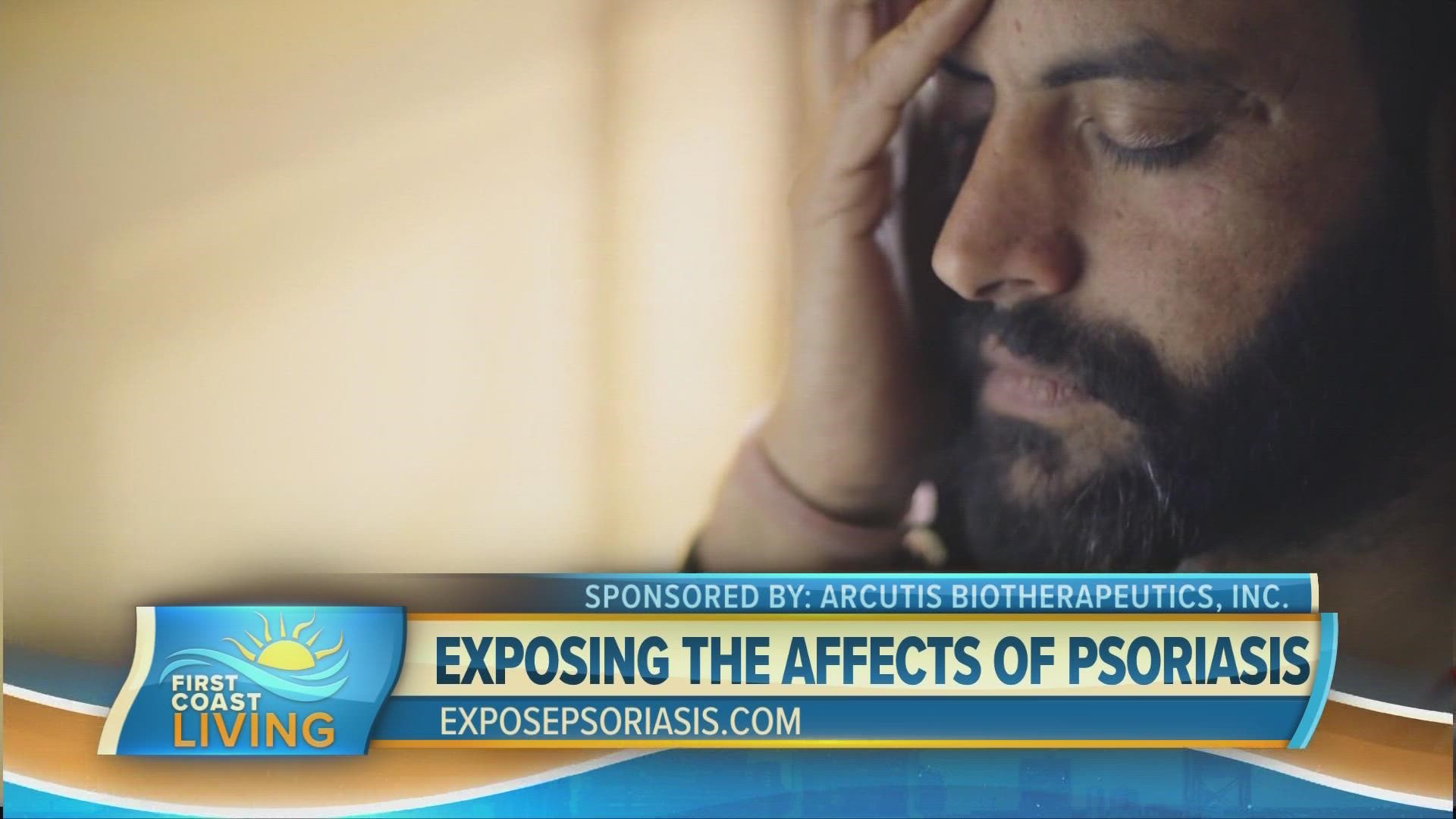 Exposing the emotional and physical affects of psoriasis (FCL Sept. 2 ...
