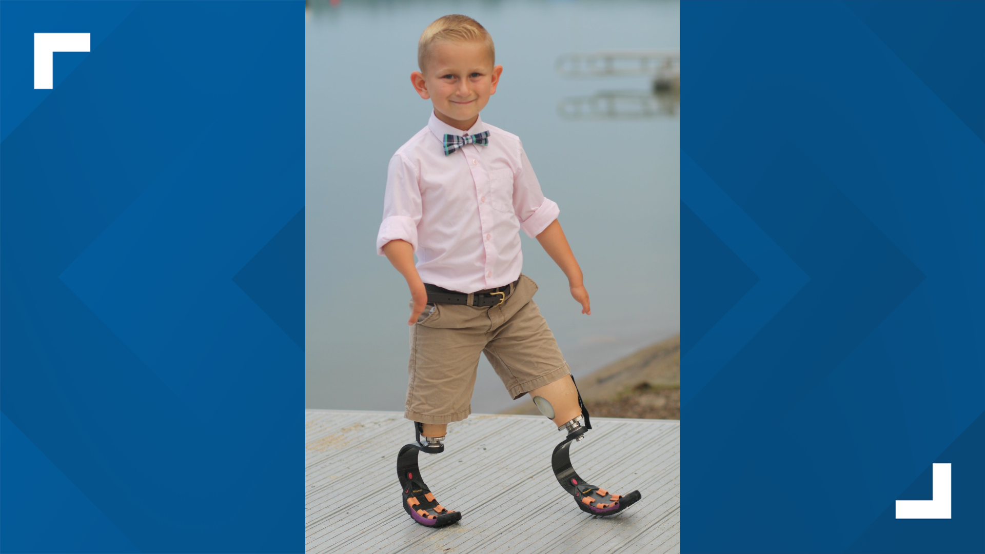 Free virtual camp this weekend for children with limb loss ...