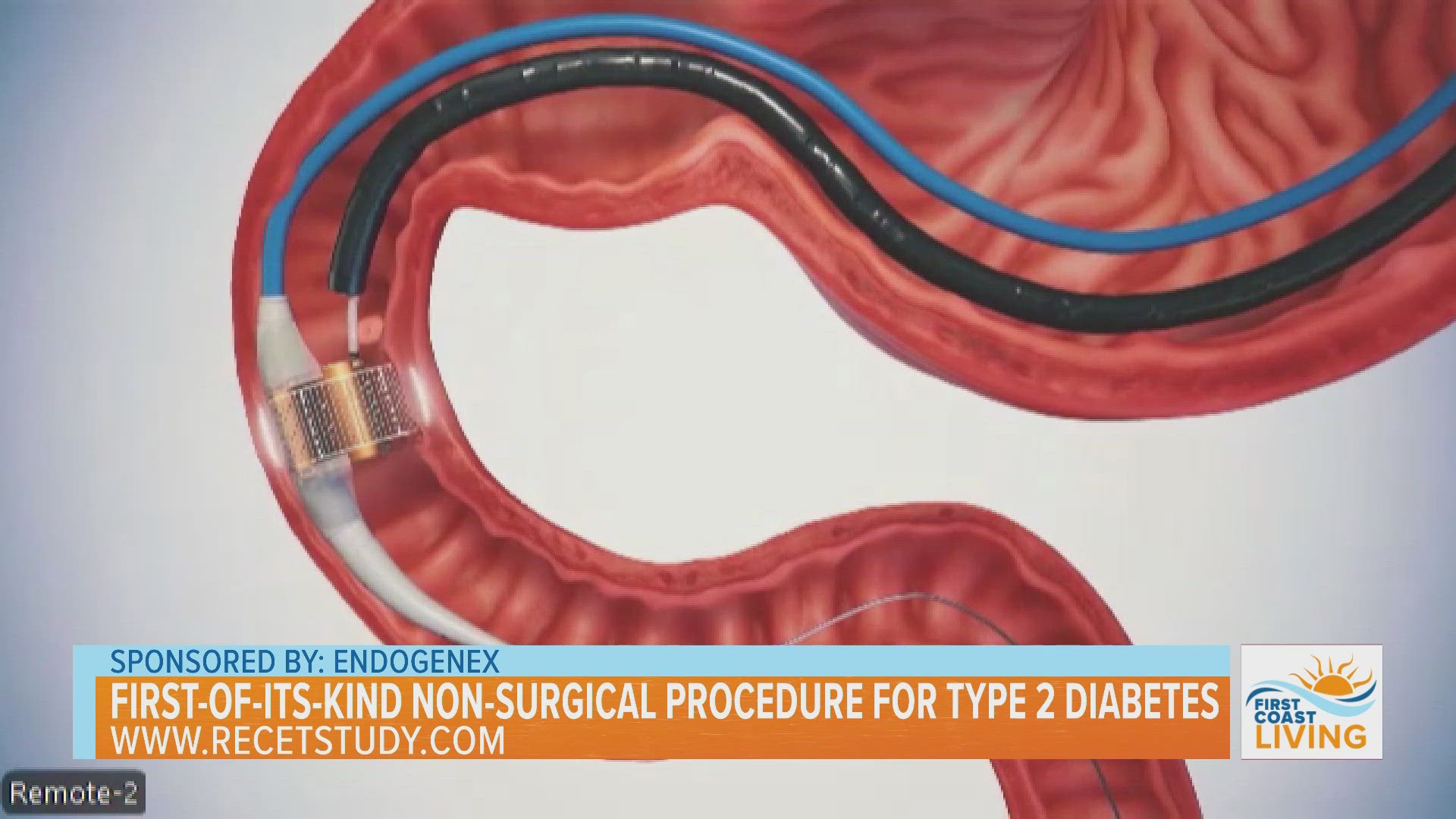 First-of-its-Kind Non-Surgical Procedure for Type 2 Diabetes ...