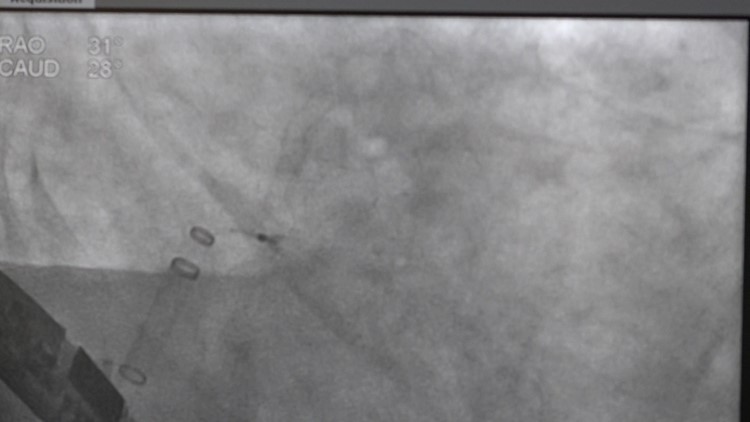 Watchman procedure cuts risk of stroke | firstcoastnews.com