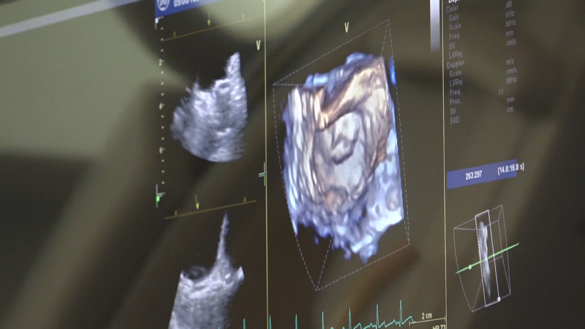 Watchman procedure cuts risk of stroke | firstcoastnews.com