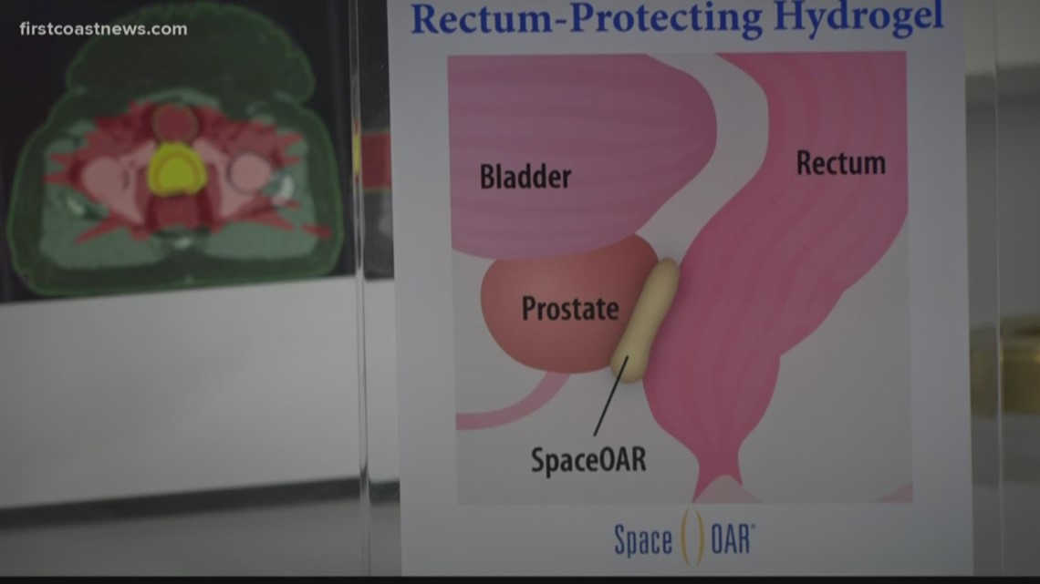 Gel minimizes side-effects from prostate cancer radiation ...