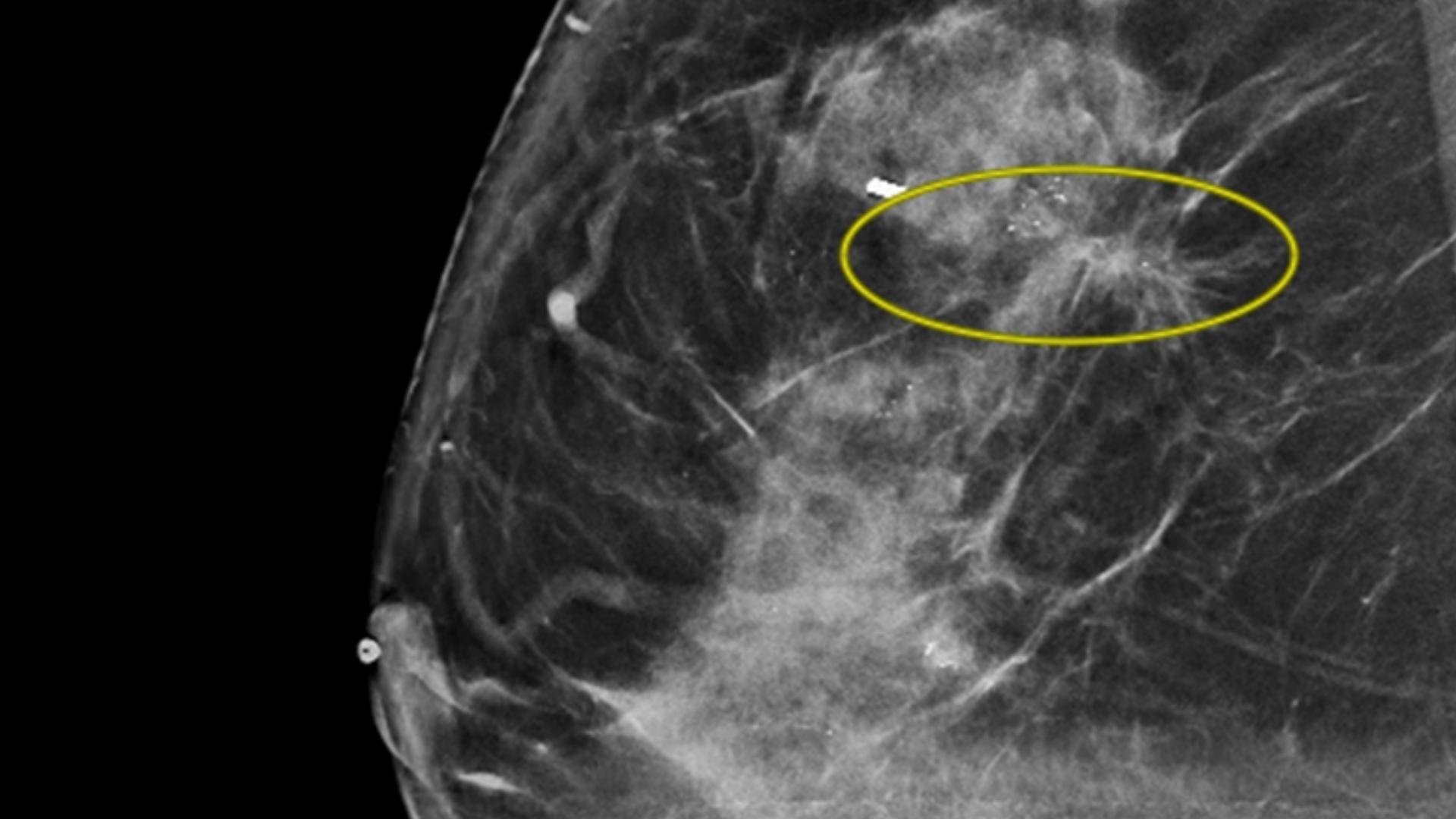 What are pleomorphic calcifications? A Jacksonville grandmother shares ...