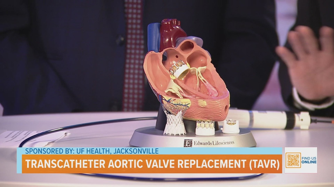 Transcatheter aortic valve replacement (TAVR) | firstcoastnews.com