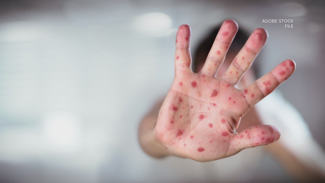 Two cases of pediatric measles reported in Jacksonville ...