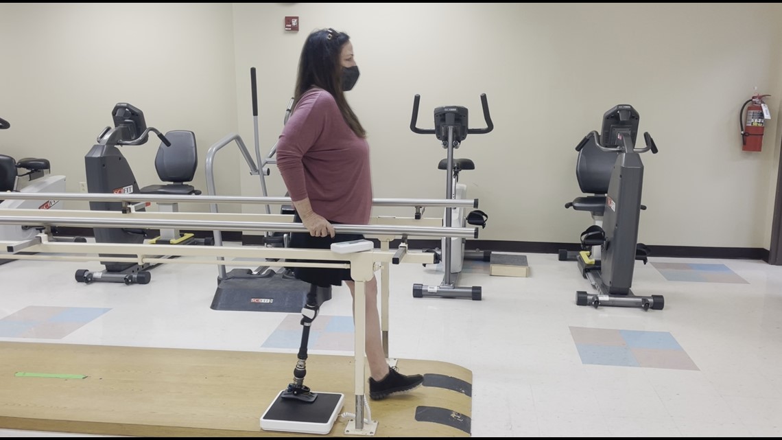 First Coast woman credits new prosthetic procedure at Mayo Clinic for ...
