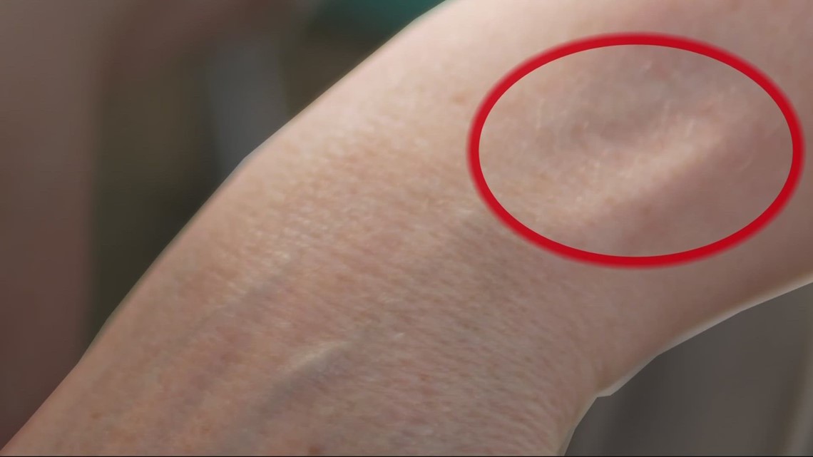 She saw a dent in her wrist where she wore her fitness tracker. What ...