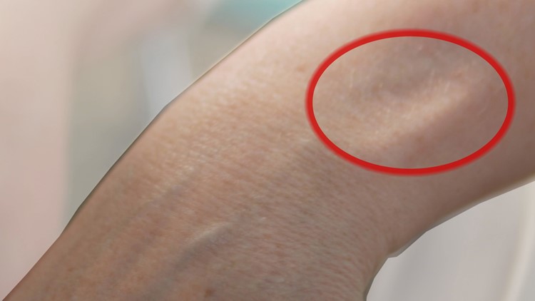 She saw a dent in her wrist where she wore her fitness tracker ...